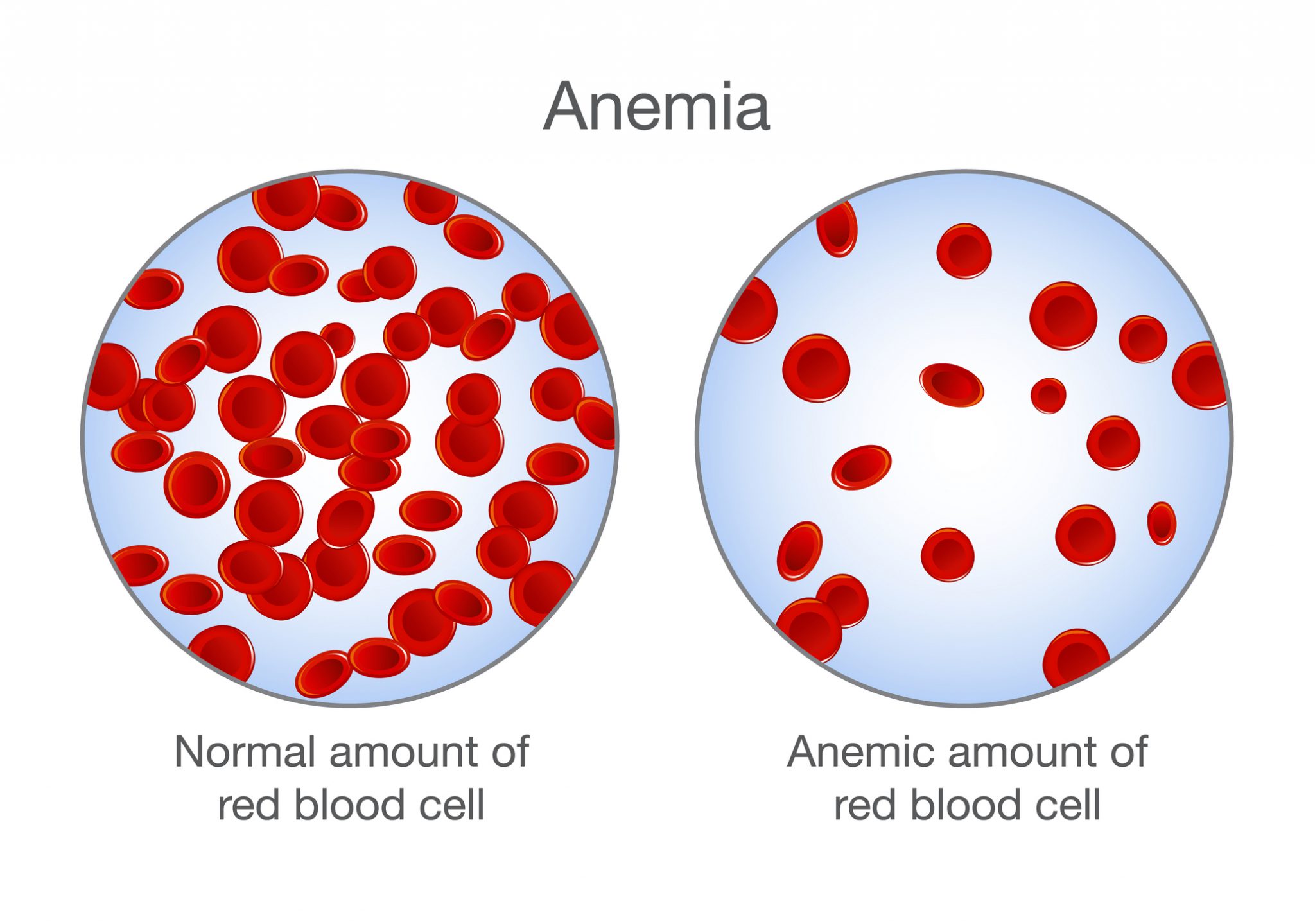 Anemia - Health BeatHealth Beat