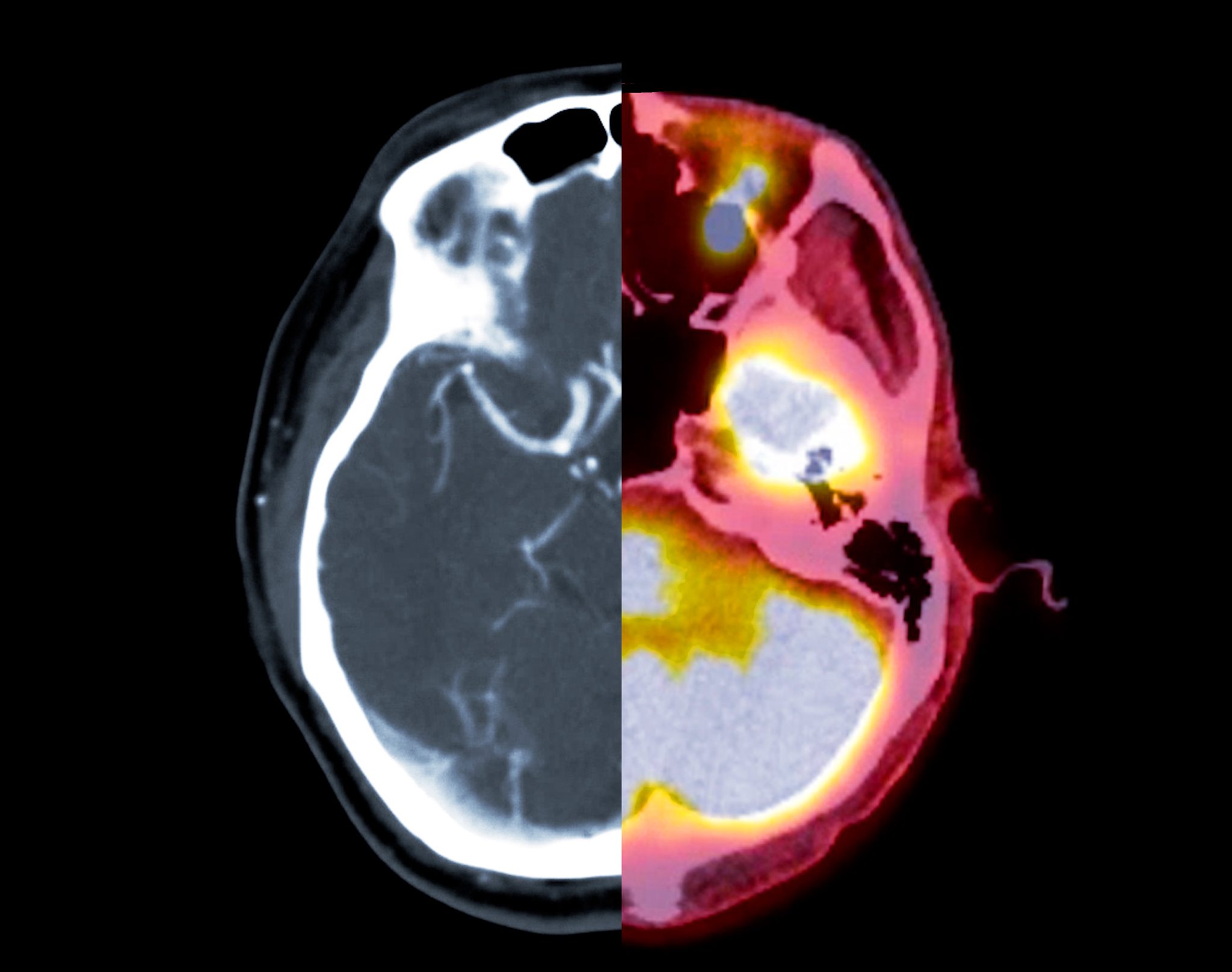 Chronic Traumatic Encephalopathy (CTE) - Health BeatHealth Beat