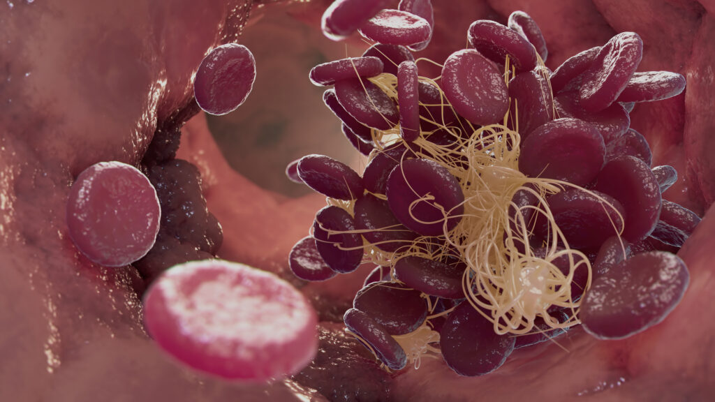 Warning Signs of Blood Clots - Health BeatHealth Beat